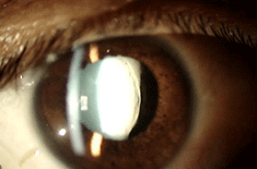 Eye Diseases - Dislocation of Lens - Eye Care Delhi, India